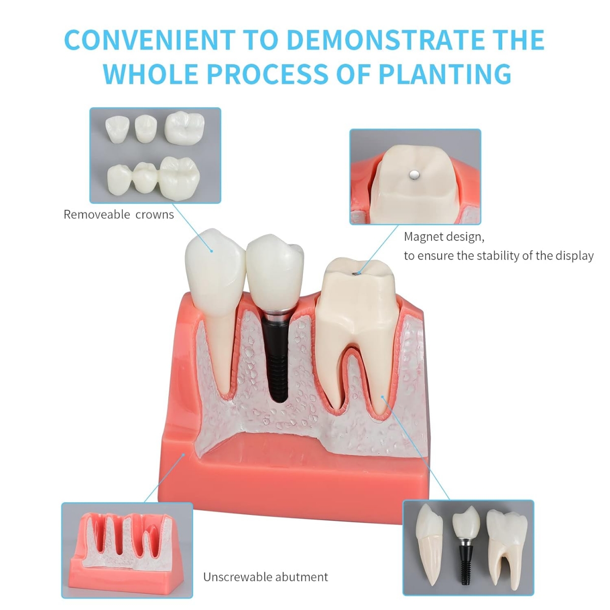Dental Implant Model - Myaskro